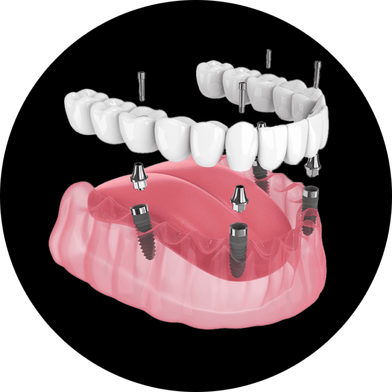 Denture Stabilization | Louisville, KY | Advanced Implant Centers